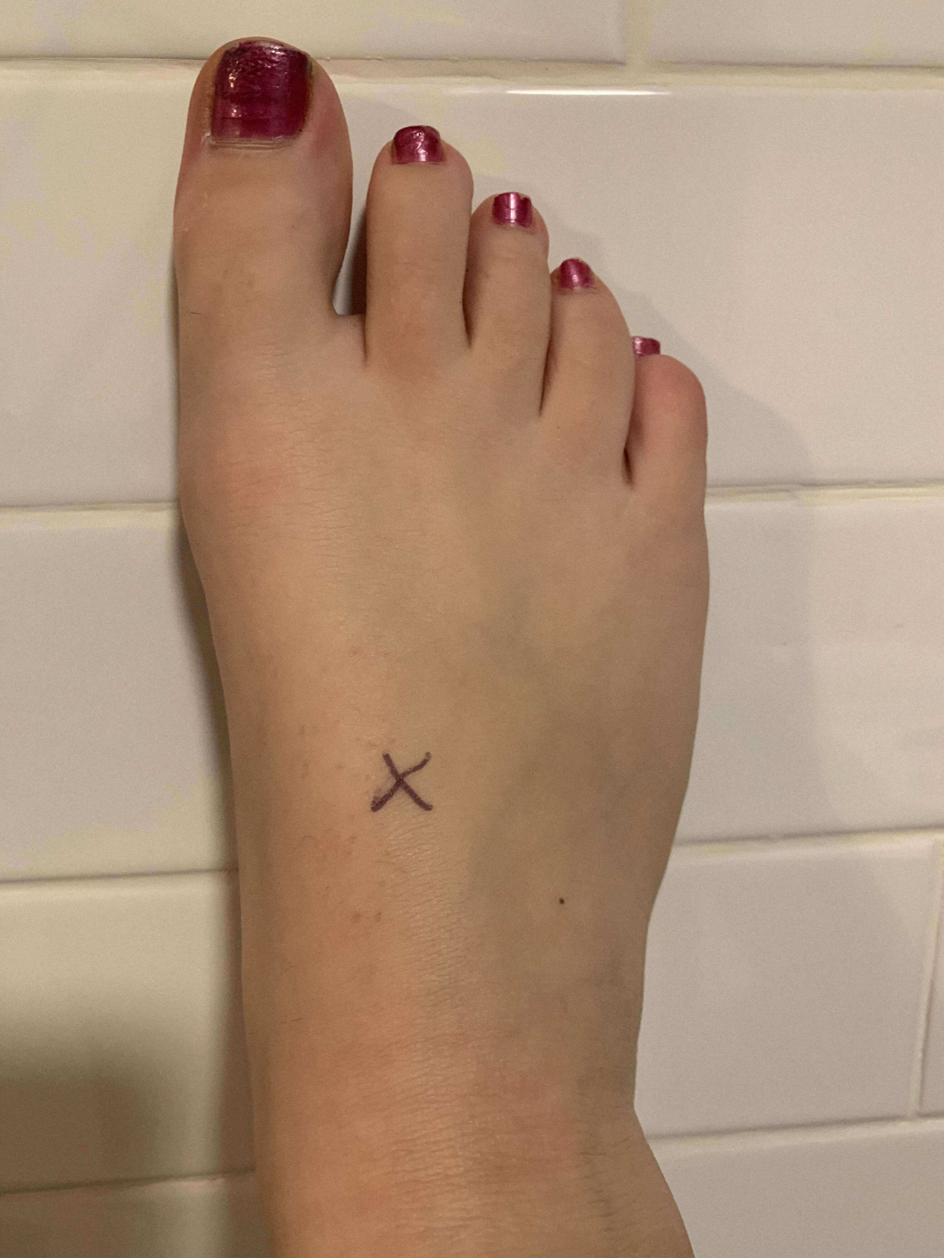 Dorsalis Pedis Pulse